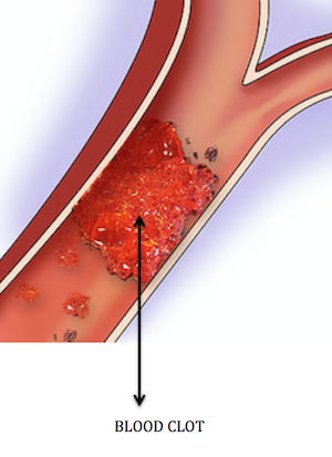 Coágulo de sangre en los pulmones: síntomas, signos y tratamiento ...