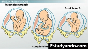Distocia fetal: posiciones fetales normales y anormales antes del parto ...