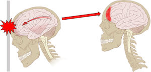Daño cerebral: signos y síntomas | Estudyando