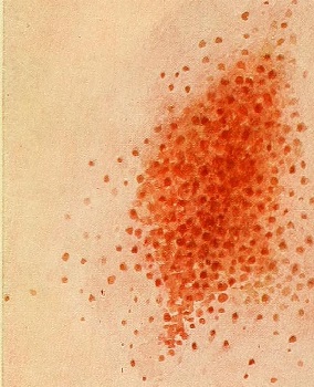 Necrosis laminar versus hemorragia petequial | Estudyando